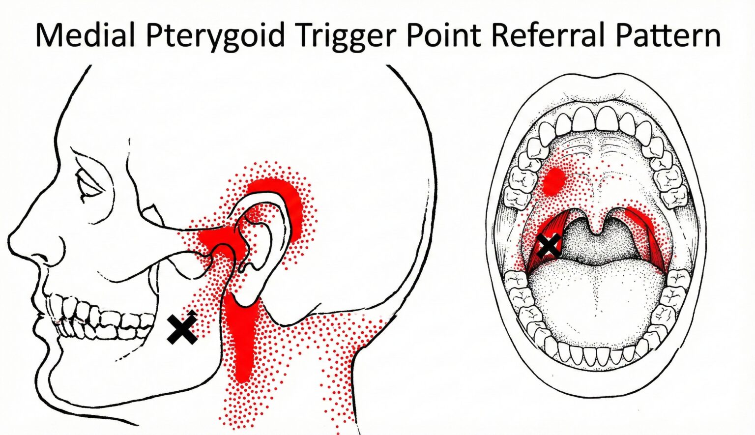 Medial Pterygoid Trigger Points: Symptoms & Relief