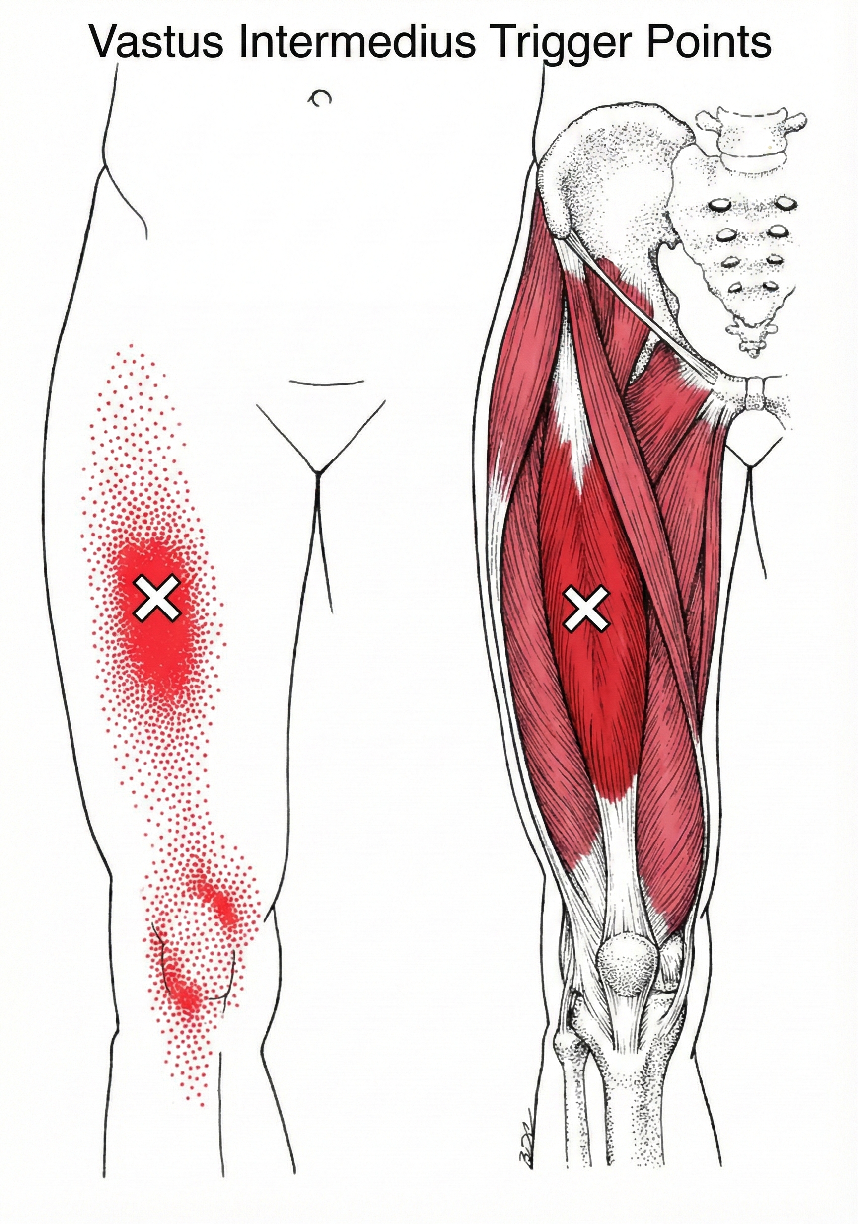 Vastus Intermedius Trigger Points | New York, NY